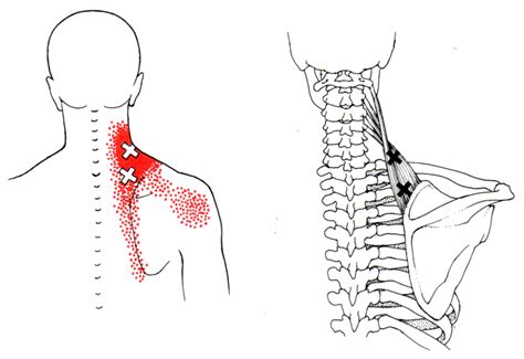 Levator Scapulae The Trigger Point Referred Pain Guide
