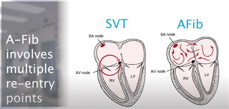 Adenosine Injection Acls Drugs Svt Adenosine Dosing Acls