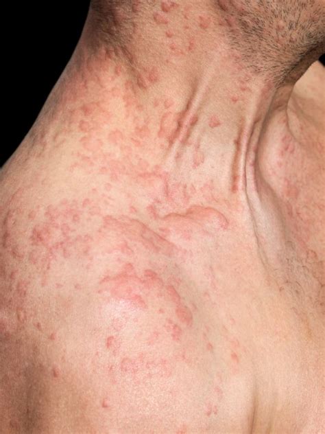 Antibiotic Levaquin May Cause Severe Sjs Skin Rash