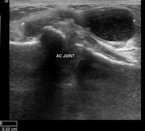 Synovial Cyst Shoulder Ultrasound