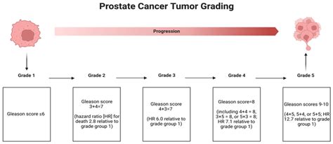 Pca Tumor Grading Using The Gleason And Isup Grading System Created Download Scientific