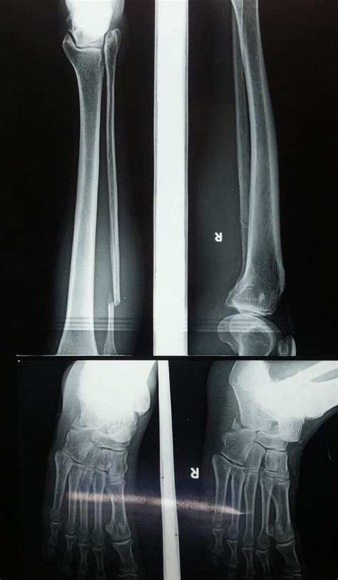 Subtalar Joint Dislocation The Foot And Ankle Online Journal