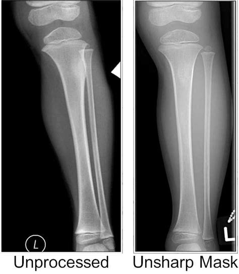 Comparison Of Two Radiographs Of The Same Patient Different Systems