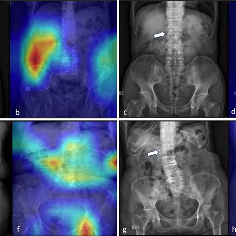 Grad Cam Assisted Image Identification Of Vertebral Fractures Aceg Download Scientific