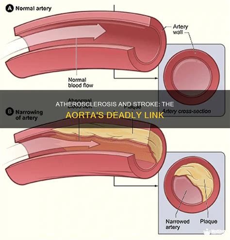 Atherosclerosis And Stroke The Aortas Deadly Link Medshun