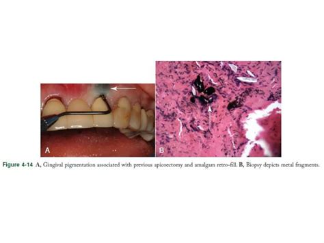 Gingivitis Classification Ppt