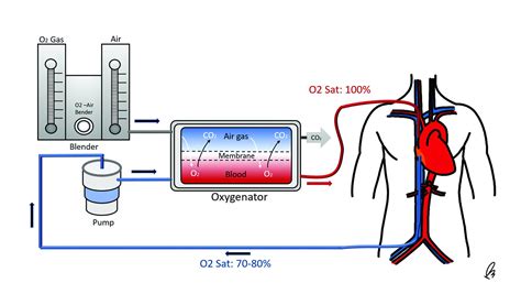 An Overview Of Extracorporeal Membrane Oxygenation Ecmo