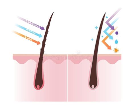 Scalp Layer Stock Illustrations 1144 Scalp Layer Stock Illustrations