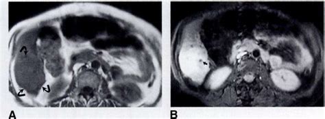 47 Year Old Woman With Peripheral Cholangiocarcinoma Download Scientific Diagram