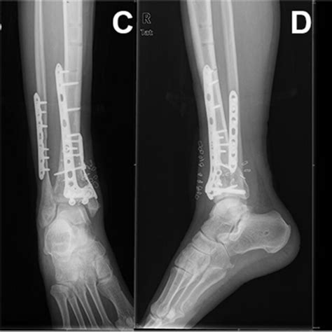 A 41 Year Old Male With Pilon Fracture Of His Left Leg From A Height