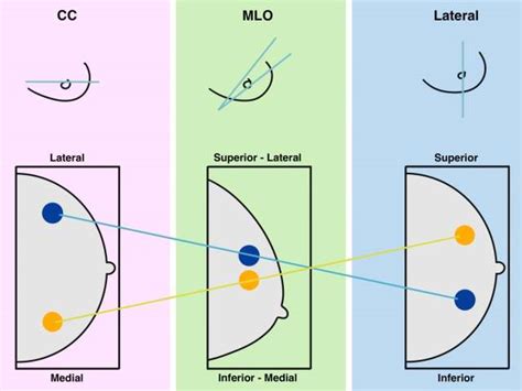 Breast Lesion Localization Radiology Ucla Health