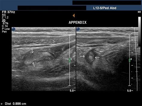 A Gallery Of High Resolution Ultrasound Color Doppler And 3d Images Appendix Ultrasound
