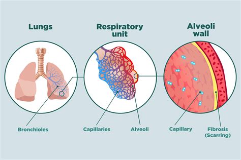 Idiopathic Pulmonary Fibrosis Life Expectancy Renew Physical Therapy