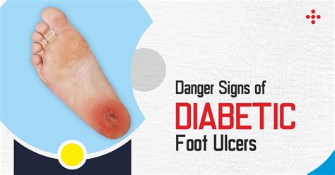 Diabetic Foot Ulcer Treatment Danger Signs Of Diabetic Foot Ulcers