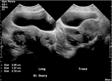 Figure From Extraovarian Sex Cord Tumor With Annular Tubules Discovered Arising From A