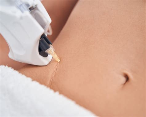 Scar Injection Skinfinity