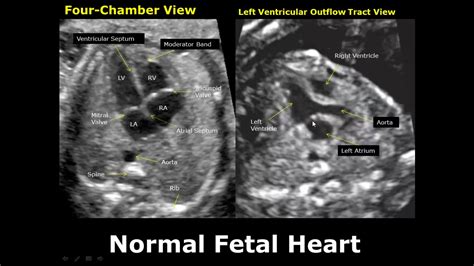 Fetal Lvot Ultrasound