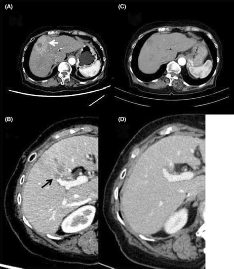 Axial Image Of Contrast‐enhanced Computed Tomography Shows A Hypodense Download Scientific