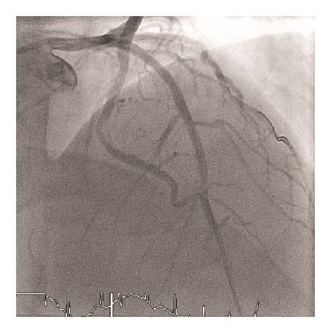 Successful Pci Of The Lad Using Gbat A Diffusely Diseased Proximal Download Scientific