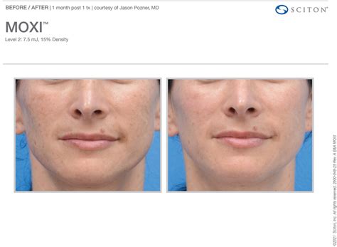 Moxi Before After CNY Cosmetic Reconstructive Surgery