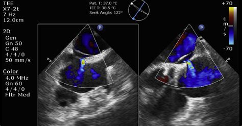 Incidental Finding Of A Double Interatrial Septum In A Patient Undergoing Atrial Fibrillation