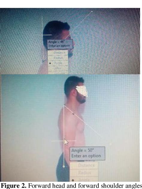 Figure 1 From Prevalence Of Postural Abnormalities Of Spine And Shoulder Girdle In Sanda
