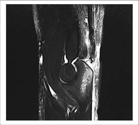 T2 Weighted Sagittal Mri Showed Full Thickness Rupture Of The Distal