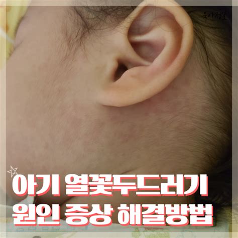 아기 열꽃 두드러기 원인과 증상 해결방법 네이버 블로그