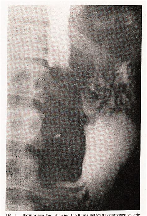Figure 1 From A Case Of Generalized Scleroderma Simulating Oesophageal