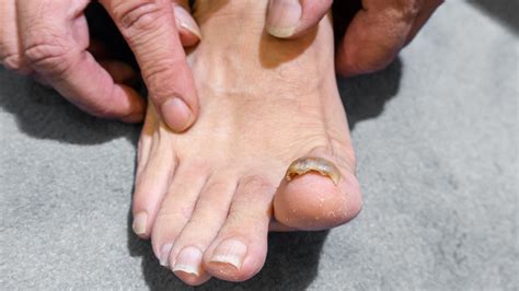 Understanding The Causes Behind Nail Ridges What They Indicate About