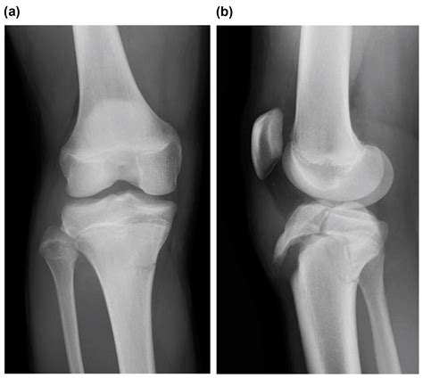 Tibial Tubercle Fracture