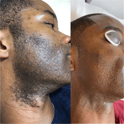 Ingrown Hair Laser Removal Nyc Ingrown Hair Laser Treatment