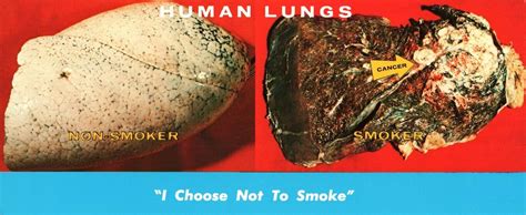Human Lungs Non Smoker Vs Smoker Cancer “i Choose Not To Smoke” Long