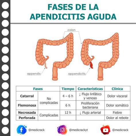 Fases De La Apendicitis Aguda Fuentespotlightmed Facebook Medicine Porn Sex Picture