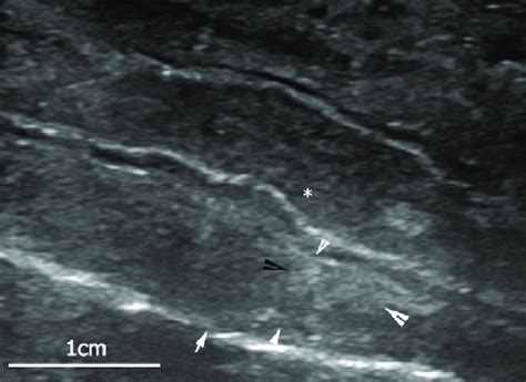 Ultrasonographic Image Showing Severe Thickening Of The Gastric Fundus Download Scientific