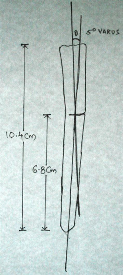 Figure 4 From Segmental Fracture Of A Cemented Femoral Stem A Case Report And Review Of