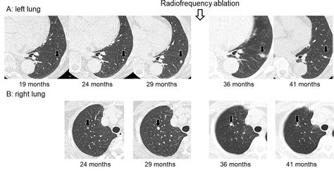 Figure 2 From Successful Treatment Of Intrahepatic Cholangiocarcinoma With Liver Lung Metastasis