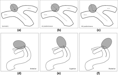 Endovascular Coil Embolization In Internal Carotid Artery Bifurcation Aneurysms Clinical Radiology