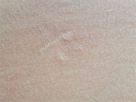 Nsfw Scars I Wanted To Show How Good My Scars Look The One Year Anniversary Of My Lap Was Was