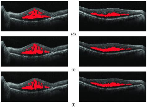 Segmentation Effect Of Different Models On The Macular Edema Area A