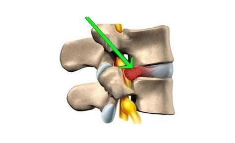 坐骨神经痛图片 坐骨神经痛症状表现图片大全 有来医生