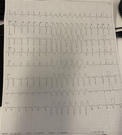 Would This Just Be Afib With Aberrent Conduction Due To The Lack Of
