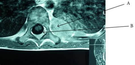 Imaging Of The Spine And Spinal Cord Concise Medical Knowledge
