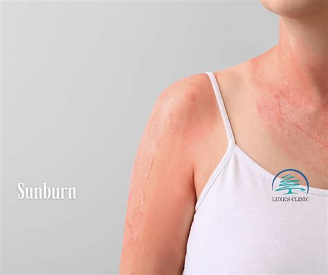 Professional Sunburn Treatment At Luxes Clinic Sunburn Relief And