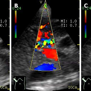Color Doppler Gain Setting Normal Portal Vein A Gain Setting Is Too Download Scientific
