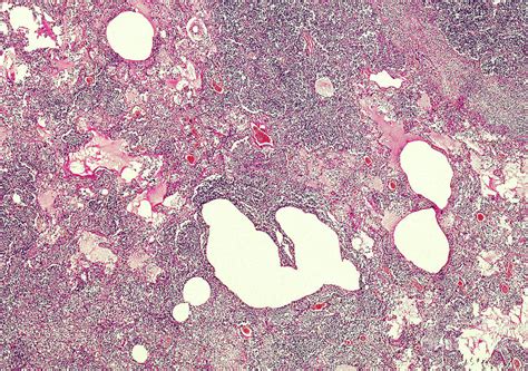 Acute Fibrinous Pleuritis Photograph By Nigel Downerscience Photo