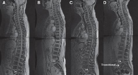 Midline Automated Spine Survey Iterative Scan Technique Assist