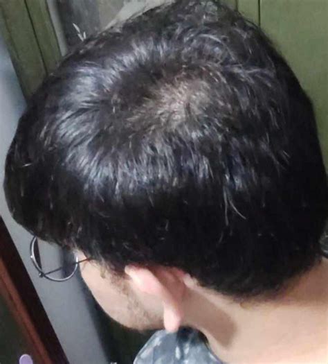 Is This Genetic Balding Rhaircare