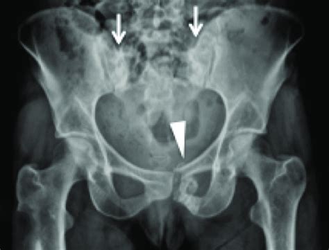 Pelvis Fracture Pillow At Jody Featherston Blog