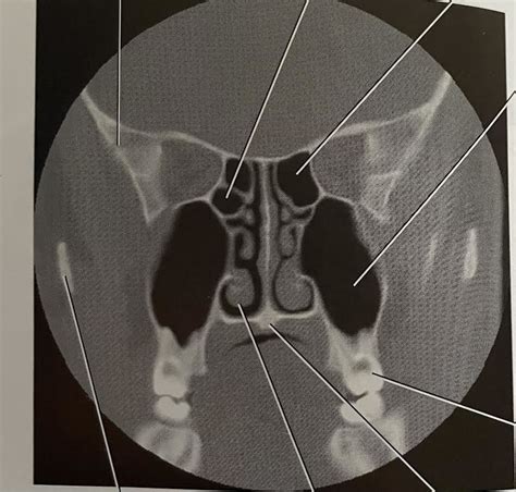 Sinus Coronal Diagram Quizlet